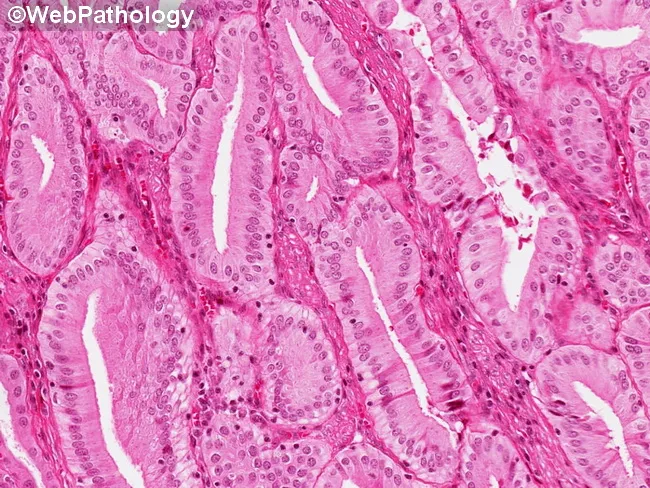Gallbladder : Papillary Hyperplasia