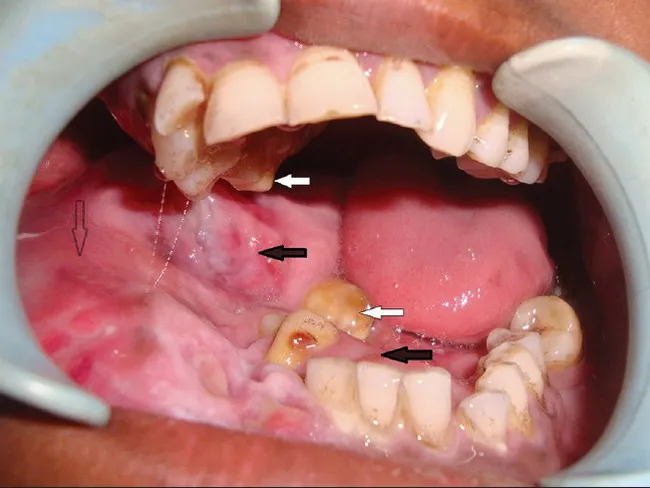 Calcifying Epithelial Odontogenic Tumor Clinical Features