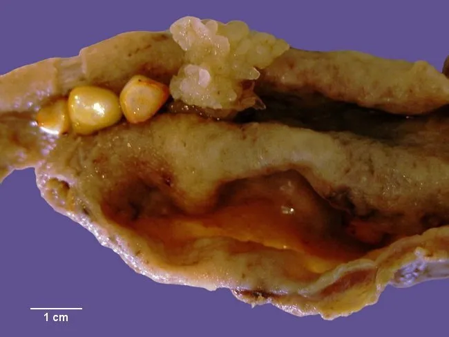 Gallbladder ICPN : Macroscopic Features