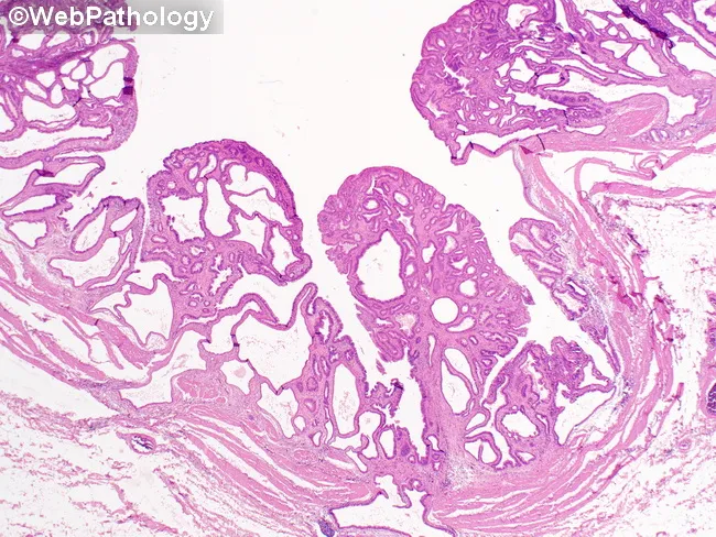 Gallbladder ICPN : Microscopic Features