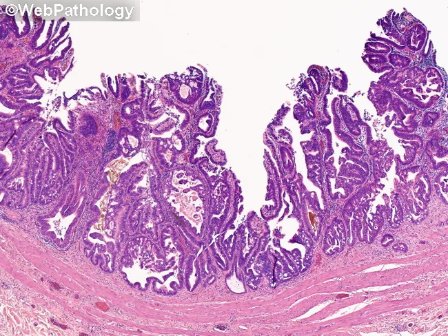 Gallbladder ICPN : Microscopic Features