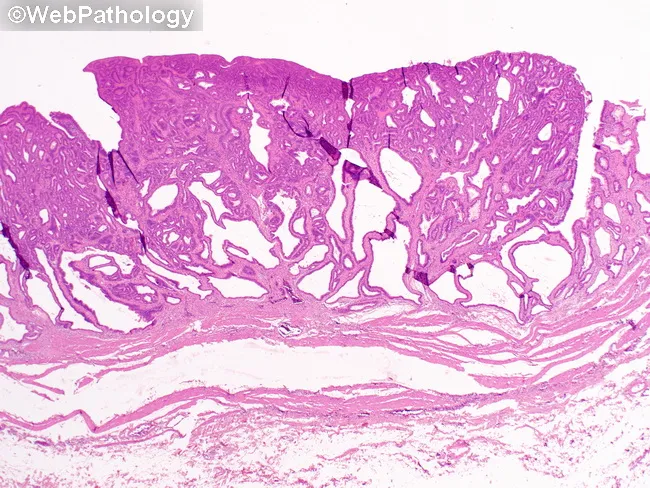 Gallbladder ICPN : Microscopic Features