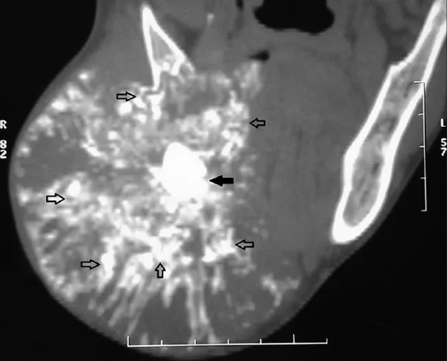 Pindborg Tumor : Radiology