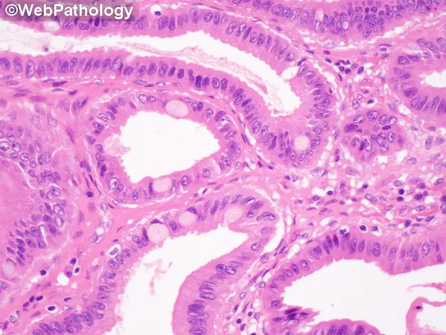 Gallbladder ICPN : Low-grade Dysplasia