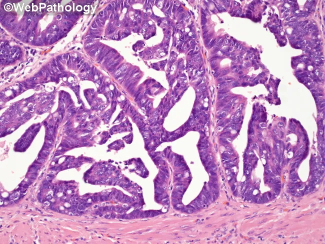 Gallbladder ICPN : High-grade Dysplasia