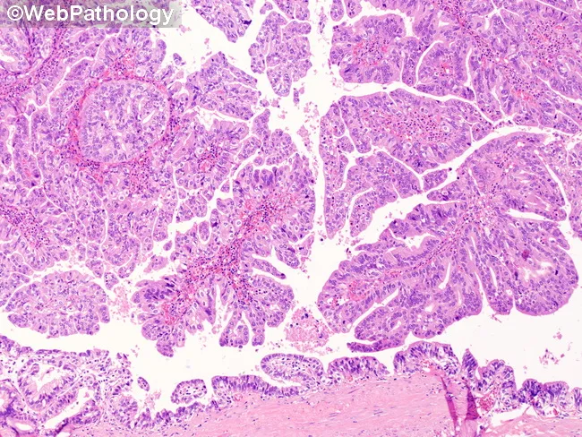 Gallbladder ICPN : Biliary Phenotype