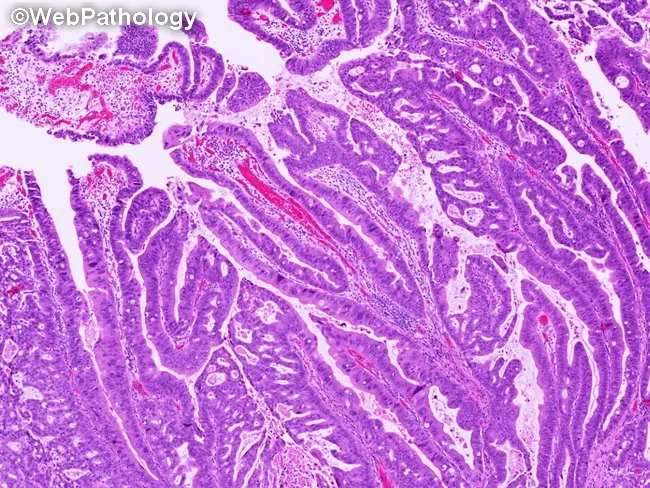 Gallbladder ICPN : Intestinal Phenotype