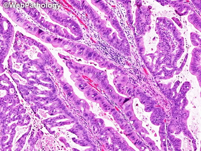 Gallbladder ICPN : Intestinal Phenotype