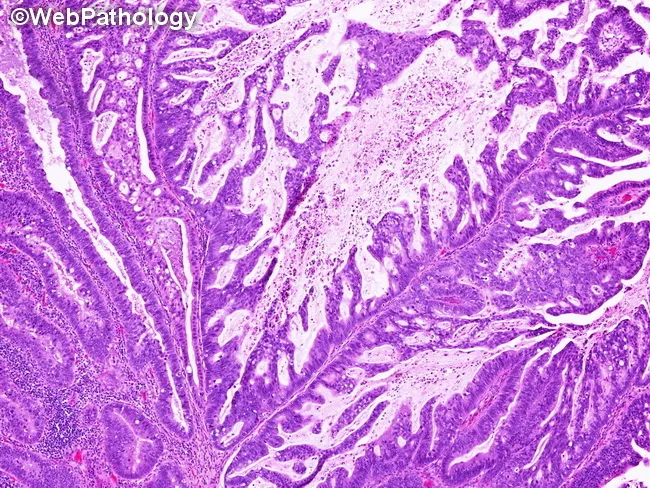 Gallbladder ICPN : Intestinal Phenotype
