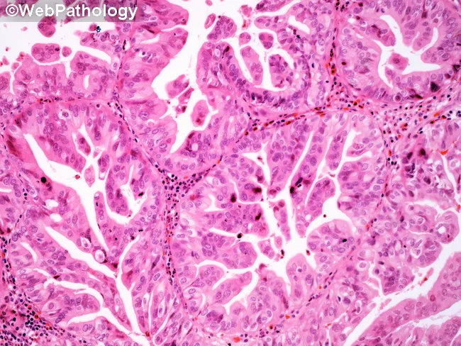 Gallbladder ICPN : Oncocytic Phenotype
