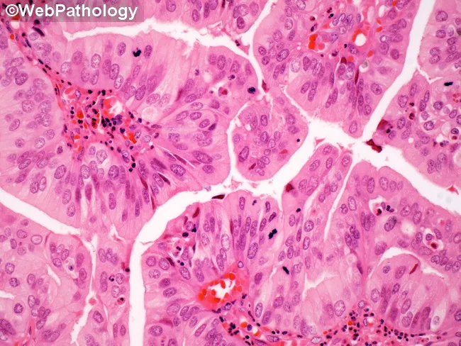 Gallbladder ICPN : Oncocytic Phenotype