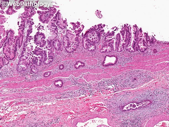 Gallbladder ICPN with Invasive Carcinoma