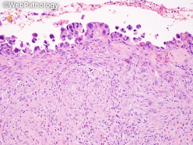 Gallbladder Dysplasia : Clinical Features