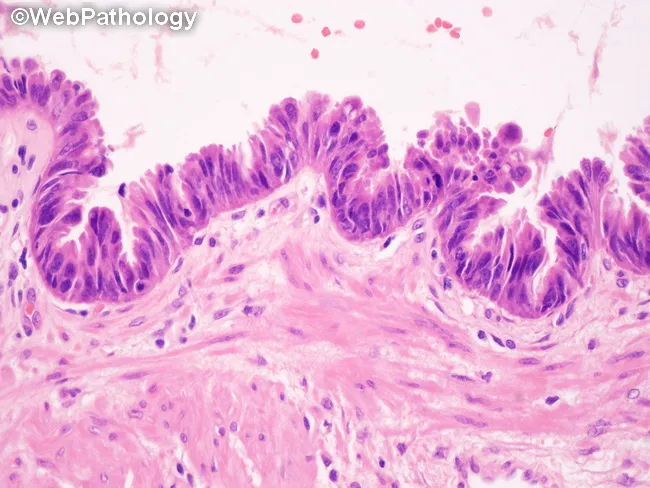 Gallbladder Dysplasia : Grading