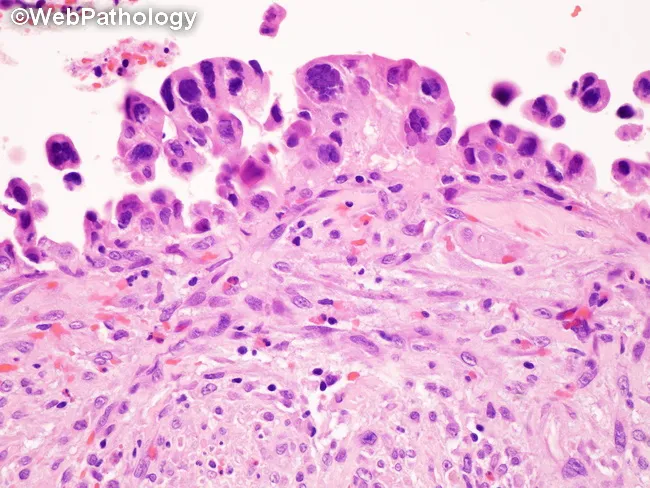 Gallbladder Dysplasia vs Reactive Changes