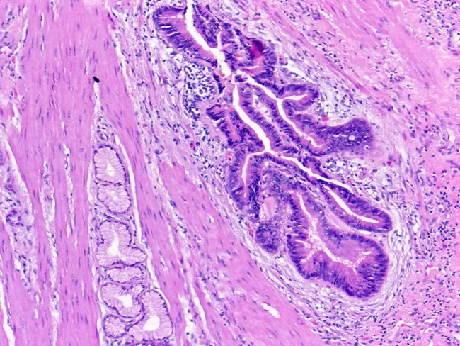Gallbladder Dysplasia in Rokitanksy-Aschoff Sinus