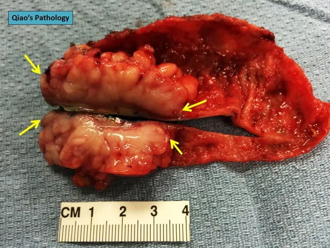 Gallbladder Carcinoma : Macroscopic Features