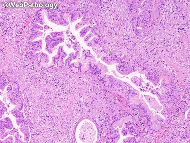 Gallbladder Carcinoma : Microscopic Features