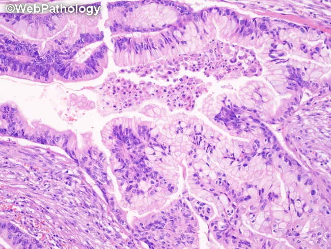 Gallbladder Carcinoma : Microscopic Features