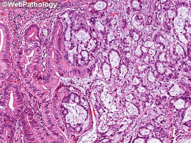 Gallbladder Carcinoma : Microscopic Features