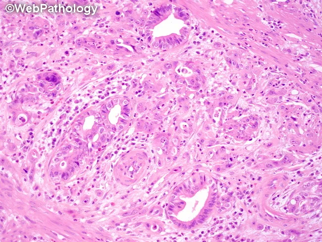 Gallbladder Carcinoma : Histologic Grading