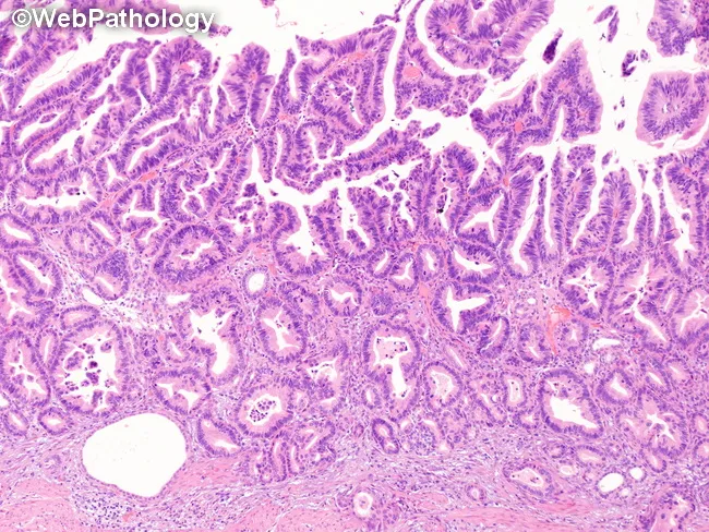 Gallbladder Carcinoma : Histologic Grading