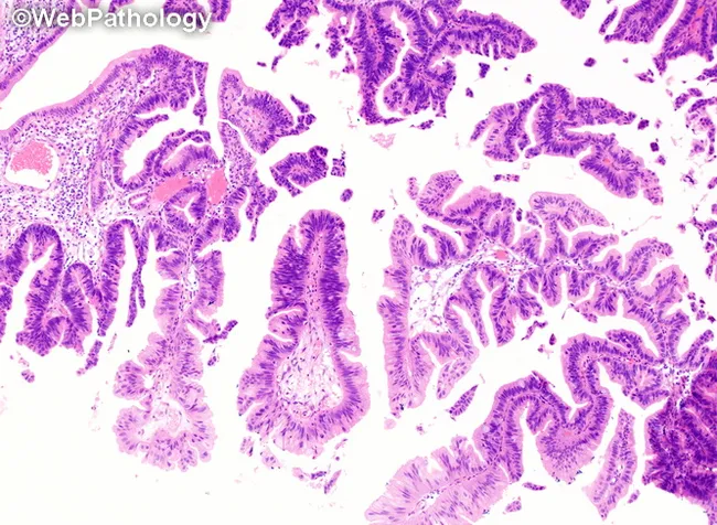 Gallbladder Carcinoma : Histologic Grading