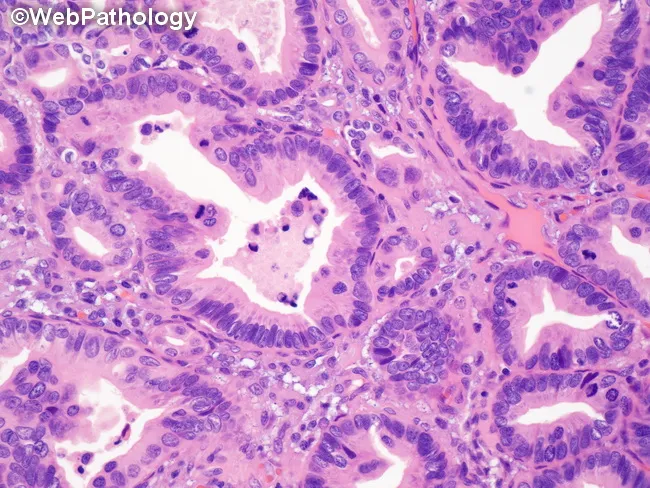 Gallbladder Carcinoma : Histologic Grading
