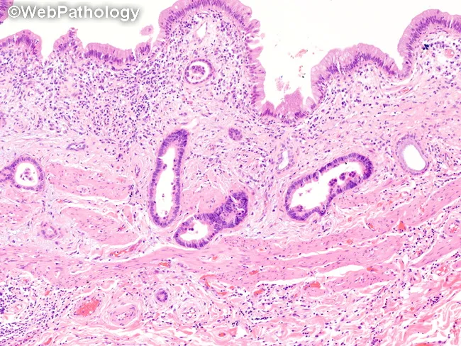 Gallbladder Carcinoma : Histologic Grading