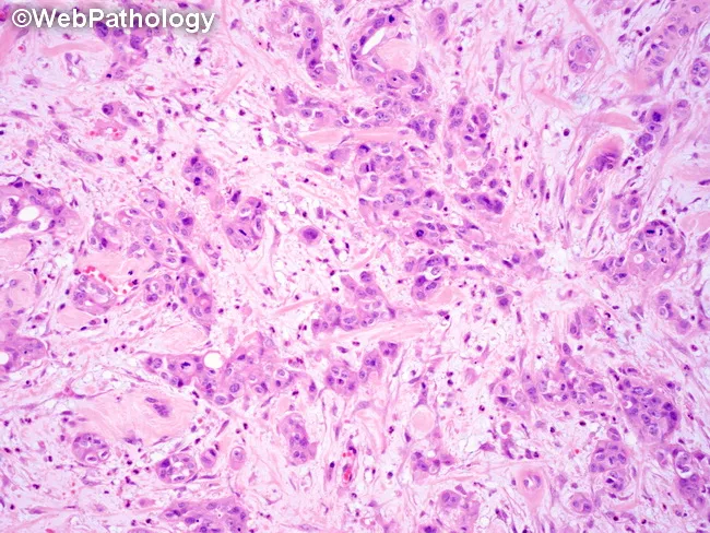 Gallbladder Carcinoma : Histologic Grading