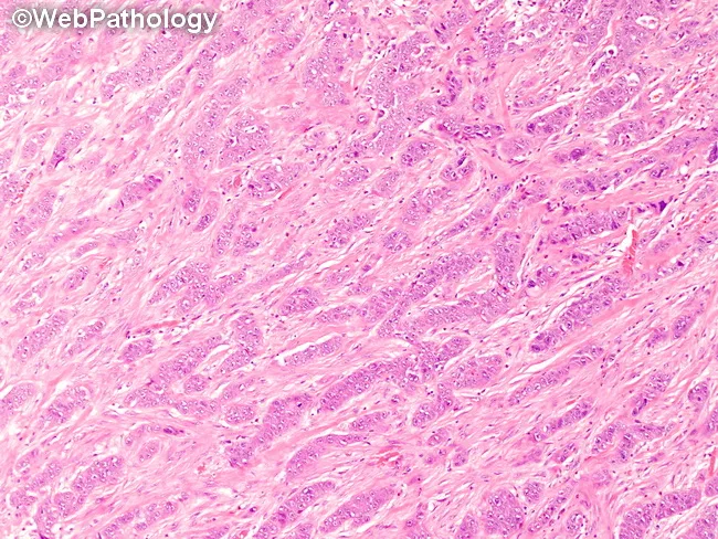Gallbladder Carcinoma : Histologic Grading