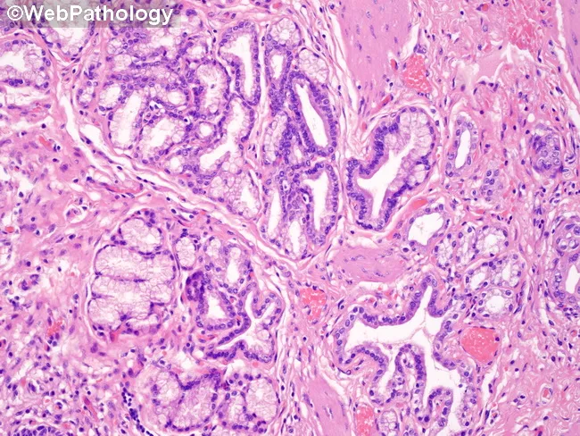 Gallbladder Carcinoma : Differential Diagnosis