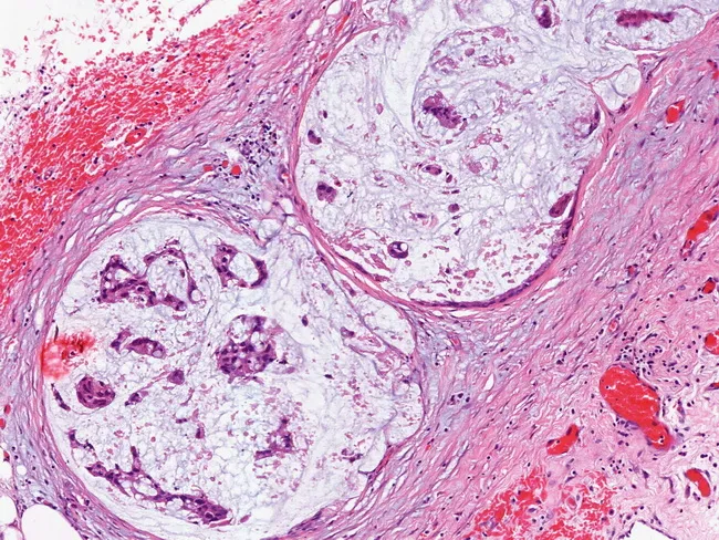 Mucinous Carcinoma of Gallbladder