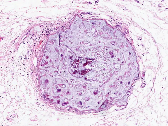 Mucinous Carcinoma of Gallbladder