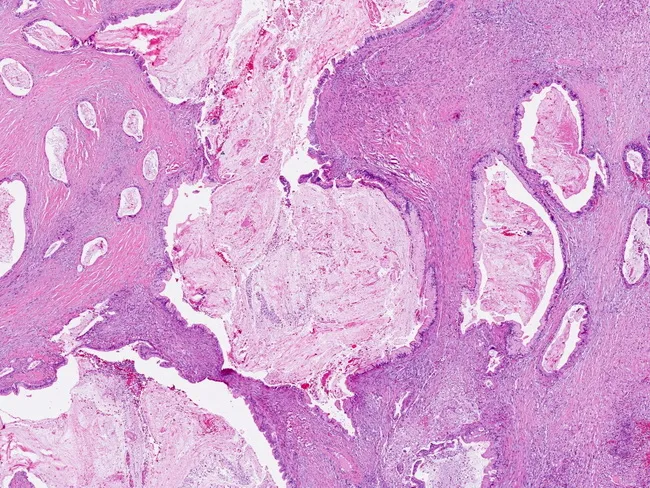 Mucinous Carcinoma of Gallbladder
