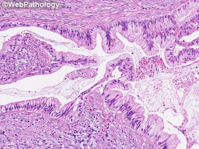 Mucinous Carcinoma of Gallbladder