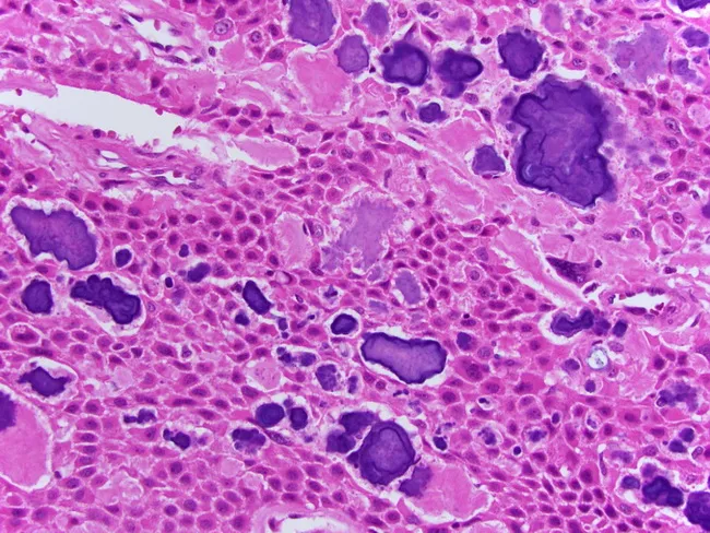 Pindborg Tumor