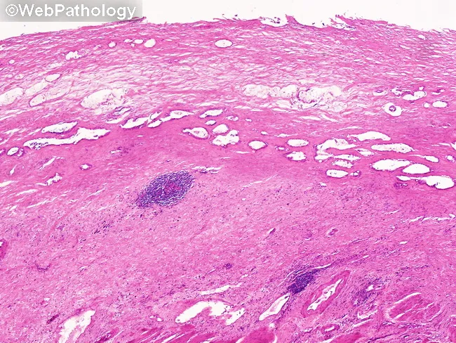 Gallbladder Carcinoma in Hyalinizing Cholecystitis