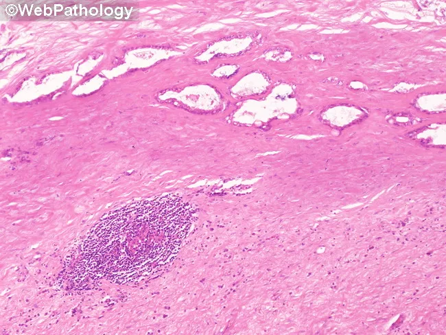Gallbladder Carcinoma in Hyalinizing Cholecystitis