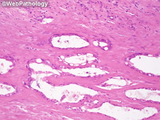 Gallbladder Carcinoma in Hyalinizing Cholecystitis