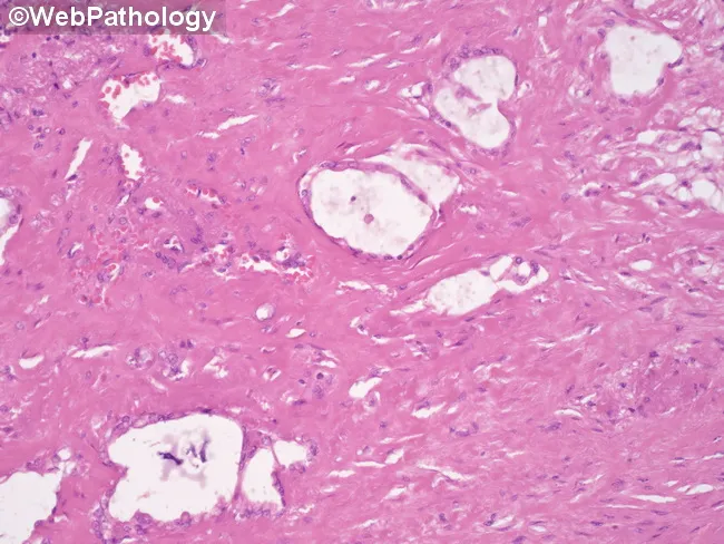 Gallbladder Carcinoma in Hyalinizing Cholecystitis