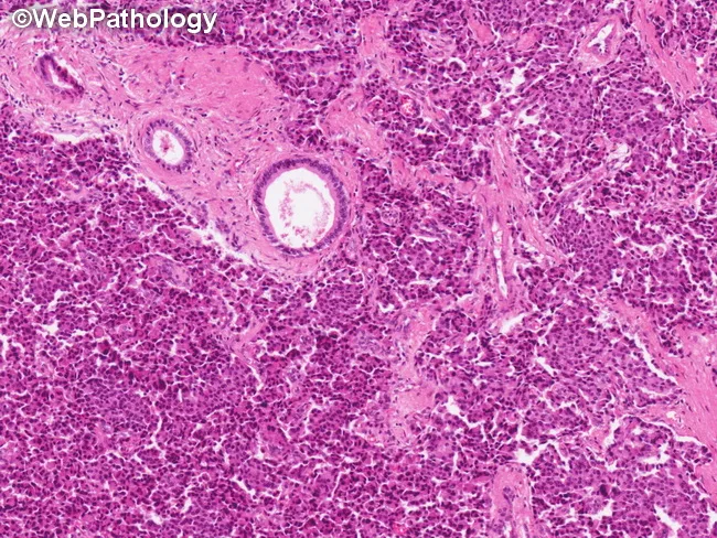 Well-differentiated Neuroendocrine Tumors