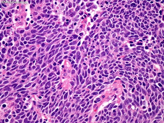 Small Cell Carcinoma of Gallbladder