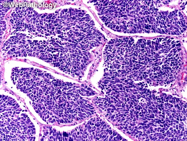 Small Cell Carcinoma of Gallbladder