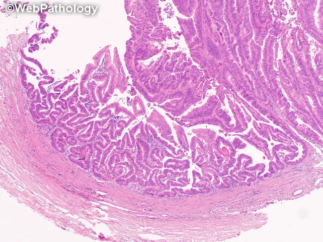 Intraductal Papillary Neoplasm of Bile Duct : Epidemiology