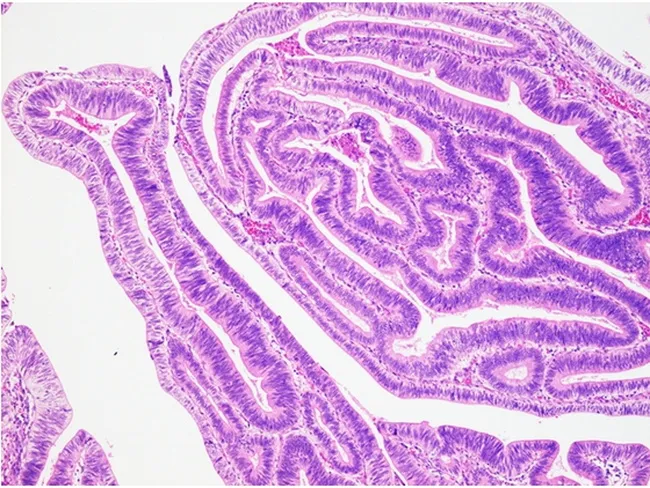 Intraductal Papillary Neoplasm of Bile Duct : Intestinal Type