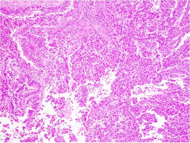 Intraductal Papillary Neoplasm of Bile Duct : Oncocytic Type