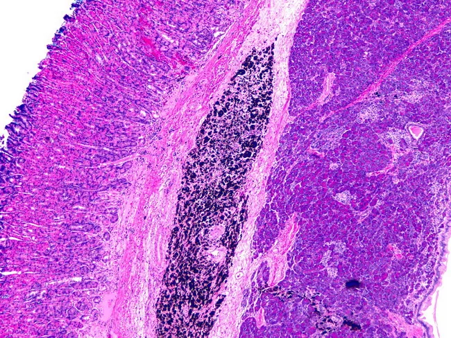 Heterotopic Pancreas : Microscopic