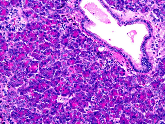 Heterotopic Pancreas : Differential