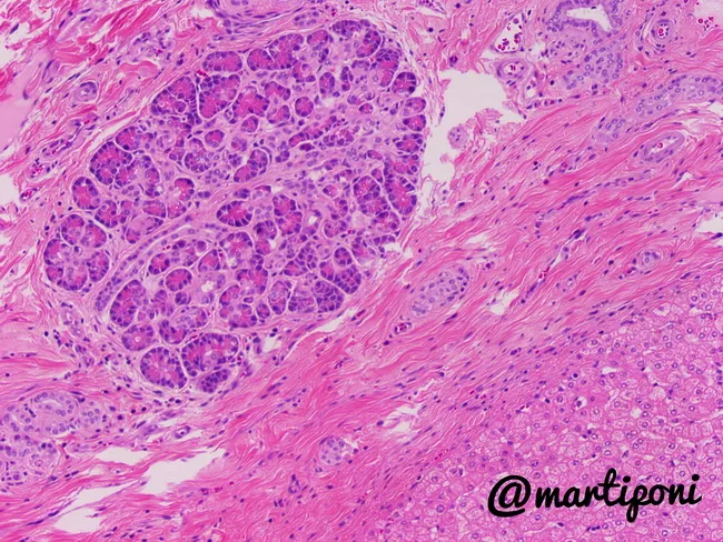 Heterotopic Pancreas : Liver